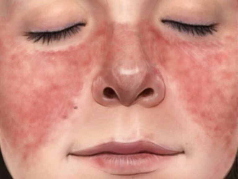 Lupus Vs Rosacea: Differences, Strong Causes And More - 2025